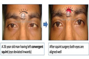 Convergent Squint - surgery - Utsav Eye Clinic