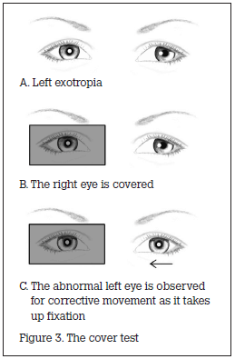 Screening for Strabismus | Squint Examination - Utsav Eye Clinic