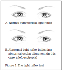 Screening for Strabismus | Squint Examination - Utsav Eye Clinic