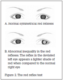 Screening for Strabismus | Squint Examination - Utsav Eye Clinic